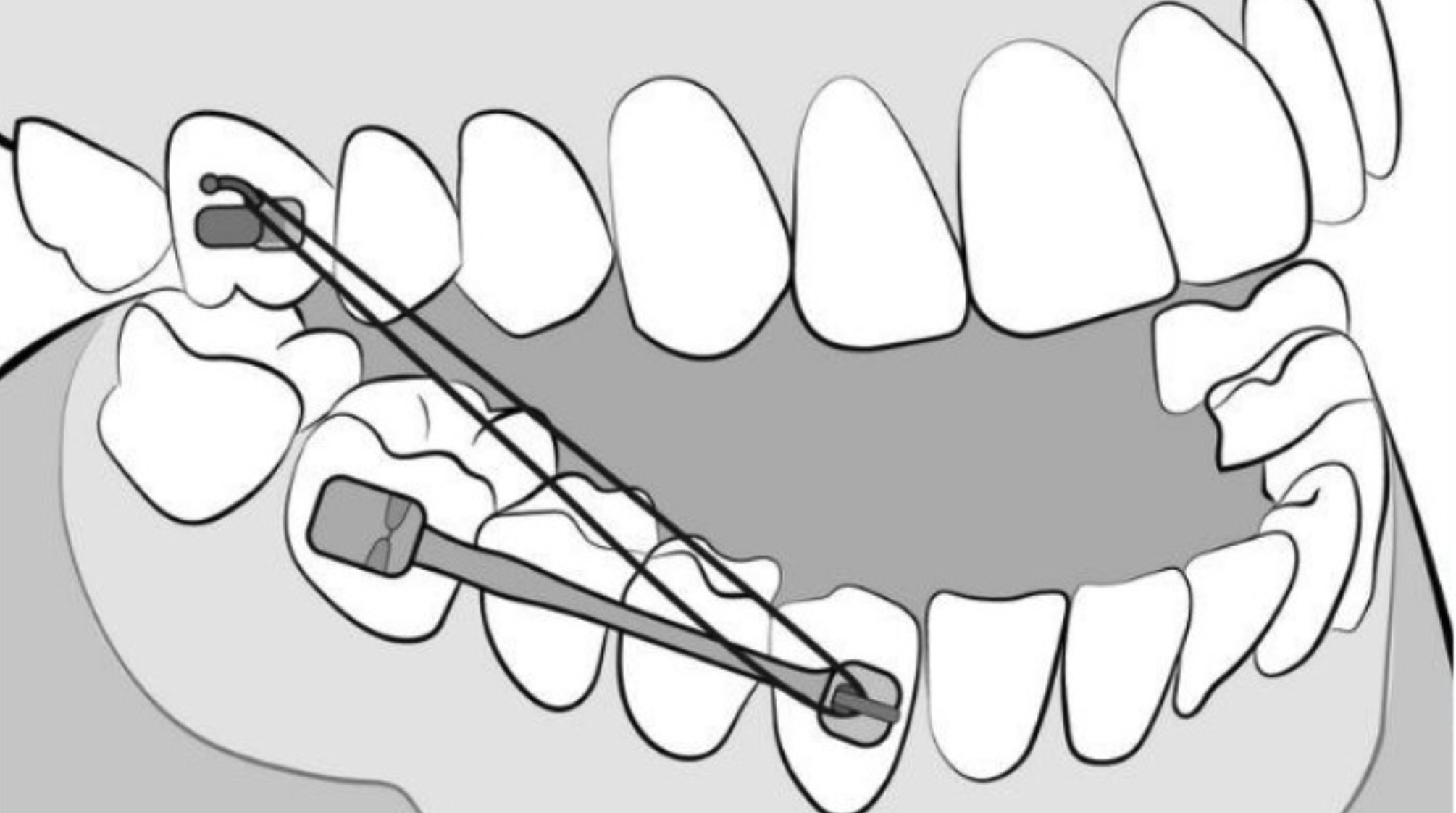 Corrección de la maloclusión de Clase III tratada con Carriere Motion.