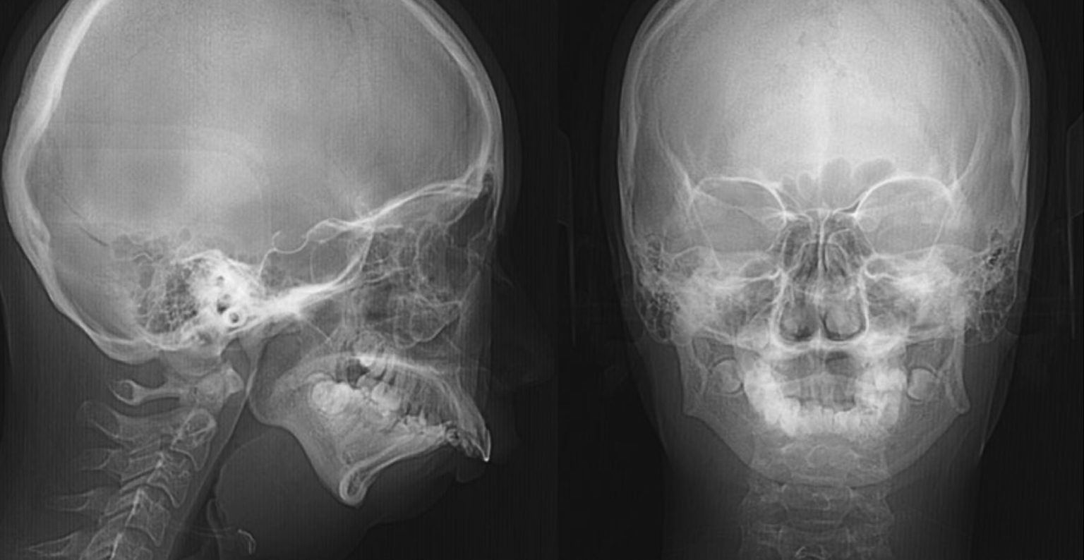 BDR CCLXXX : Micrognatia mandibular con anquilosis de la articulación ...