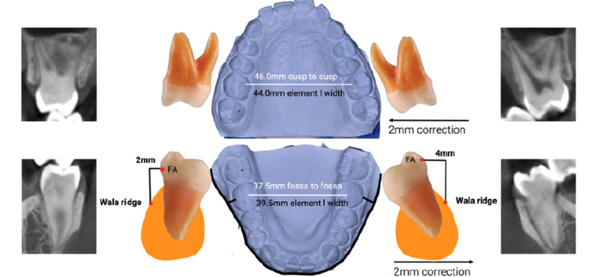 Tratamiento de una Brodie Bite en un paciente adolescente