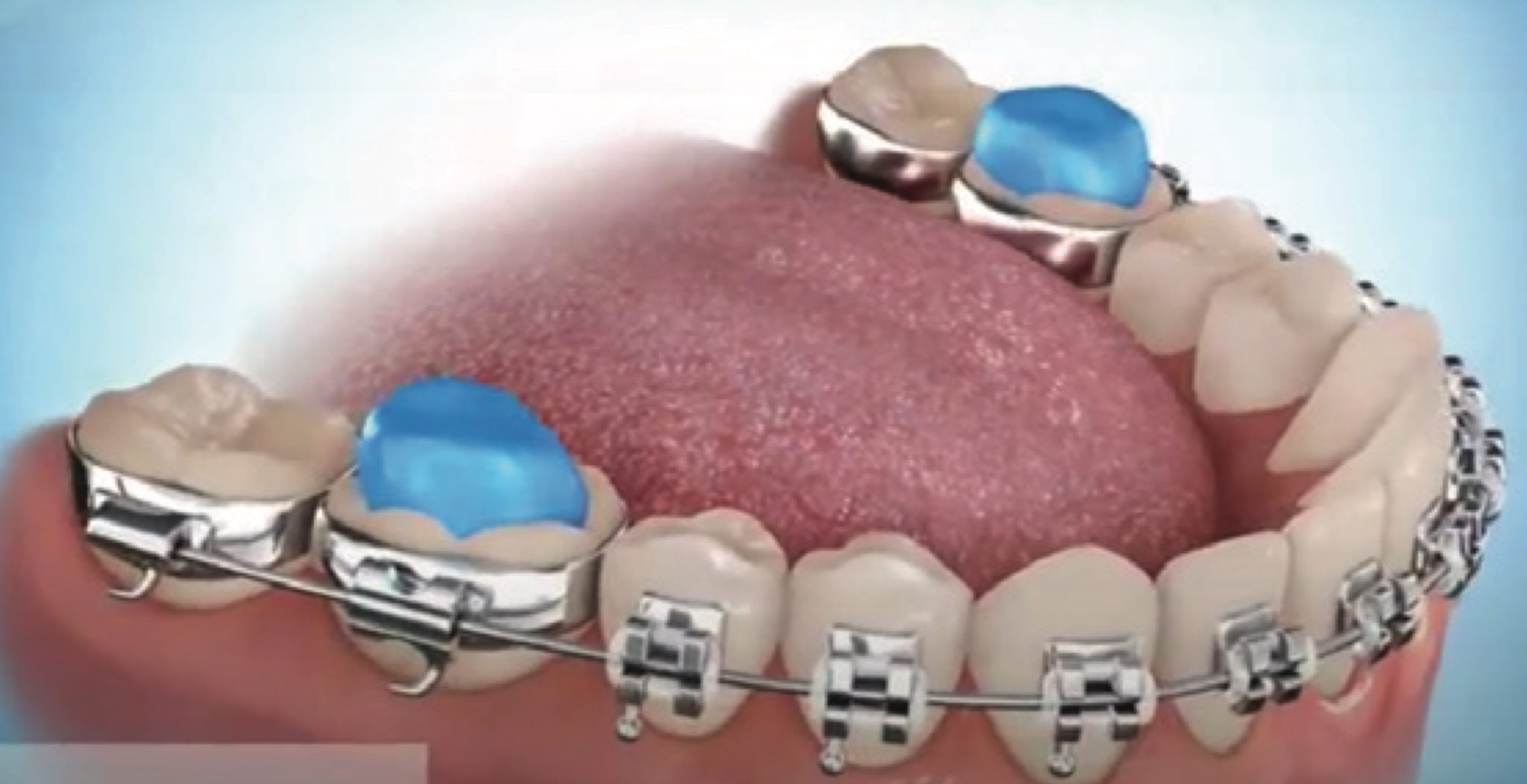 El uso de bite turbos en el tratamiento ortodoncia, una revisión de ...