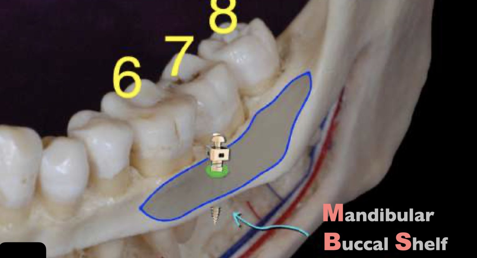 Ubicación Para Mini Implantes En El Shelf Mandibular E Infracigomático