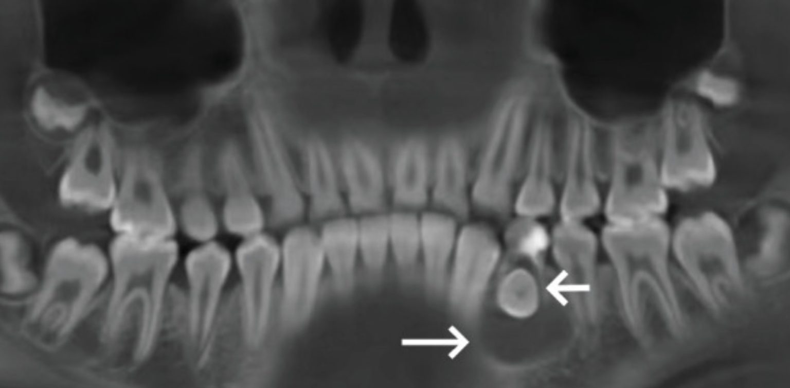 Tratamiento de un premolar impactado con dilaceración radicular causada ...